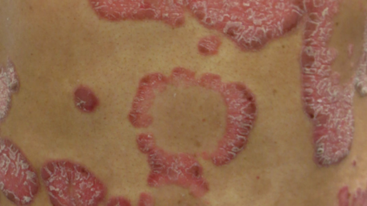 What is Psoriasis - FBIO